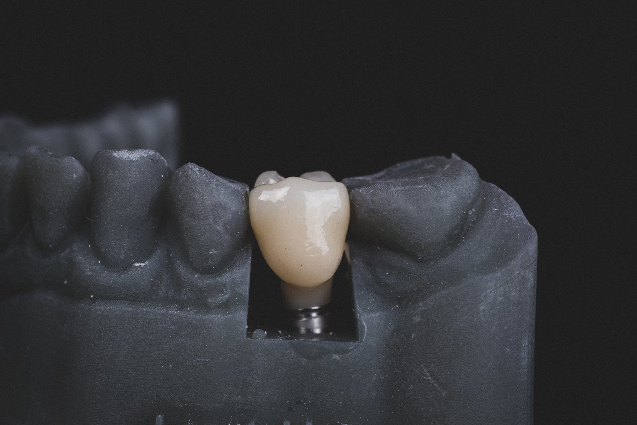 What is immediate implant placement?