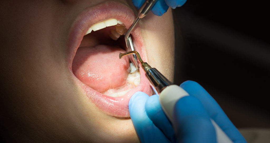 Piezoelectric Bone Surgery in Dental Extractions and Implants